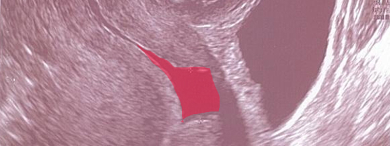 Isthmocèle - Docteur Benchimol : Gynécologue-obstétricien à Paris, France